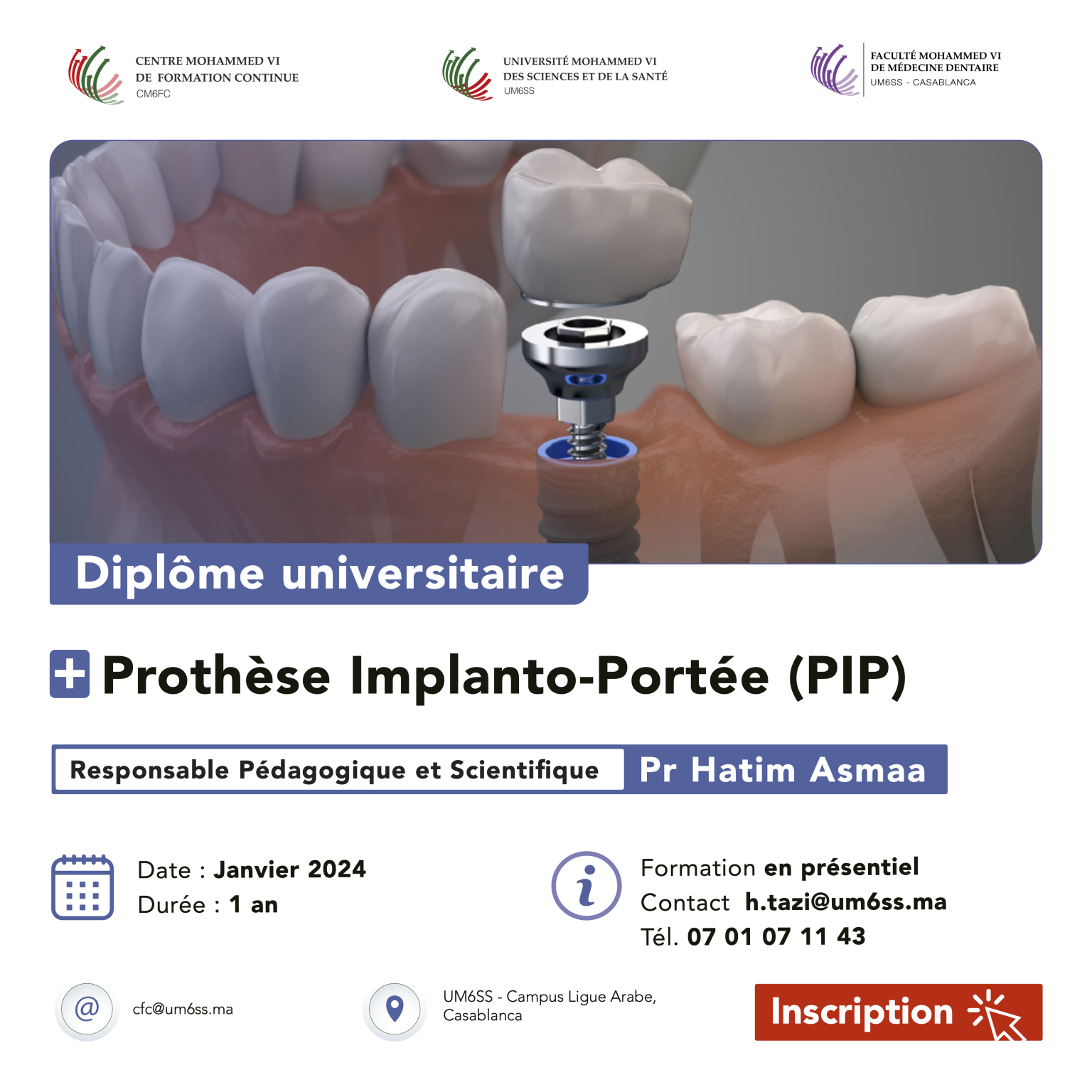 DU de prothèse Implanto-Portée – PIP (Février 2025 ) – Centre Mohammed ...